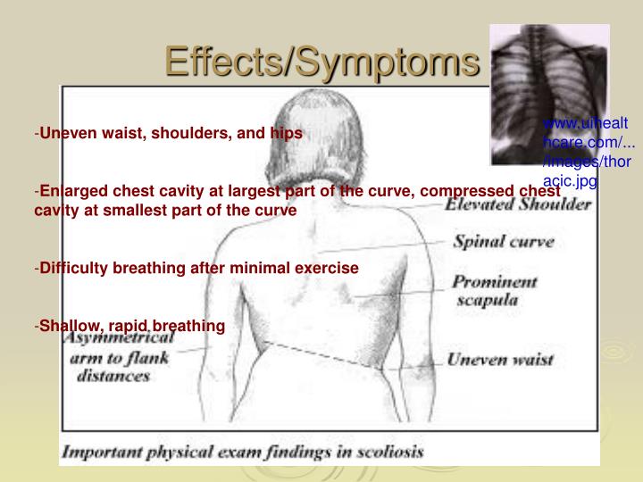 PPT - Scoliosis PowerPoint Presentation - ID:4874282