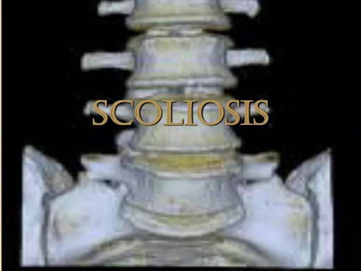 PPT - Scoliosis PowerPoint Presentation, free download - ID:4874282