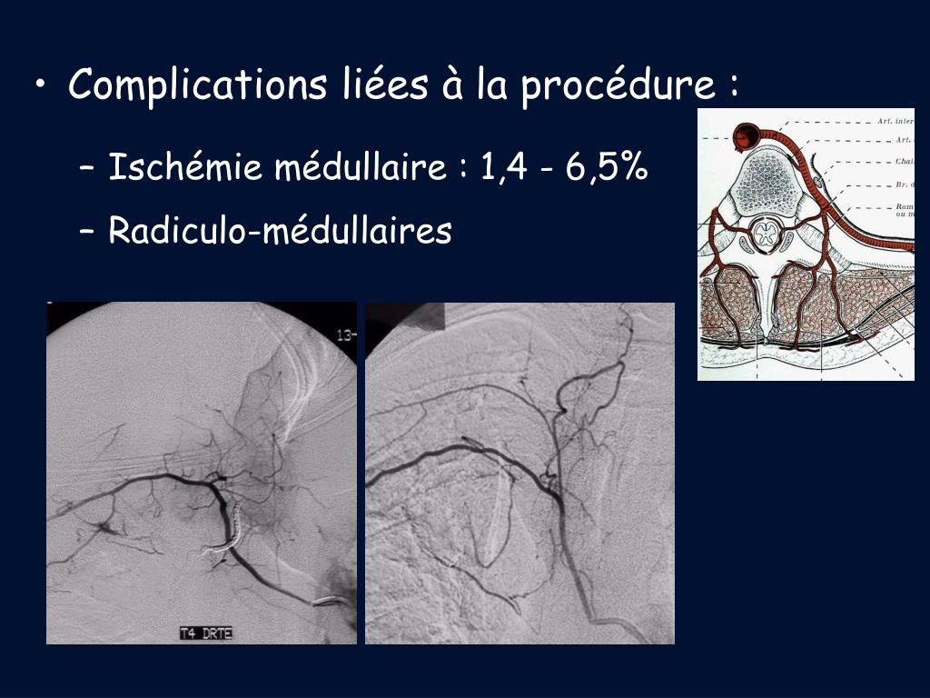 PPT - Hémoptysies menaçantes place de la radiologie interventionnelle ...