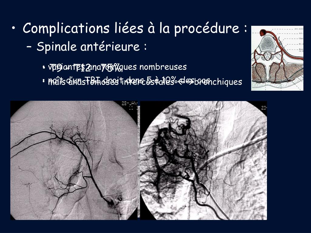 PPT - Hémoptysies menaçantes place de la radiologie interventionnelle ...