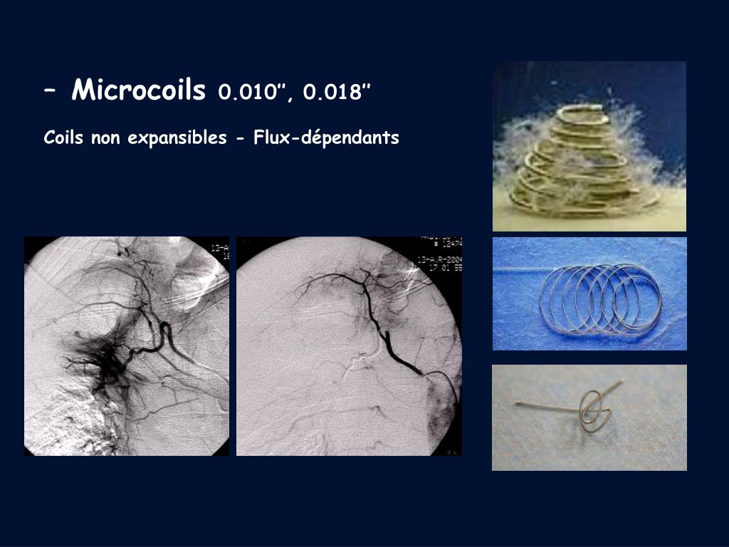 PPT - Hémoptysies menaçantes place de la radiologie interventionnelle ...