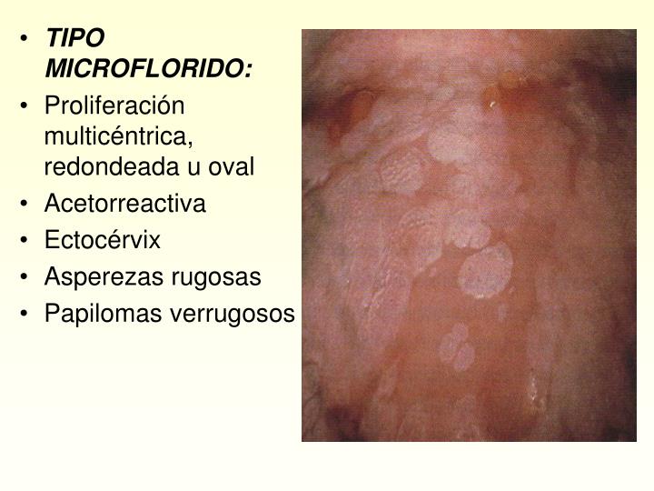 PPT - VIRUS PAPILOMA HUMANO CONDILOMATOSIS PowerPoint Presentation - ID ...
