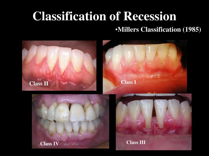 PPT - Periodontal Aesthetics PowerPoint Presentation - ID:4890149