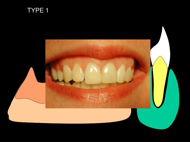 PPT - Periodontal Aesthetics PowerPoint Presentation - ID:4890149