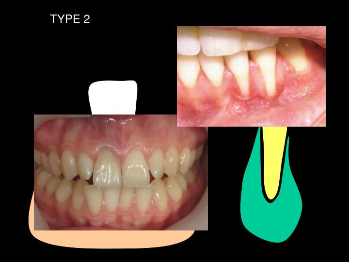 PPT - Periodontal Aesthetics PowerPoint Presentation - ID:4890149