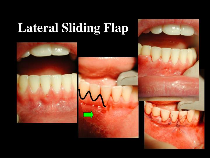 PPT - Periodontal Aesthetics PowerPoint Presentation - ID:4890149
