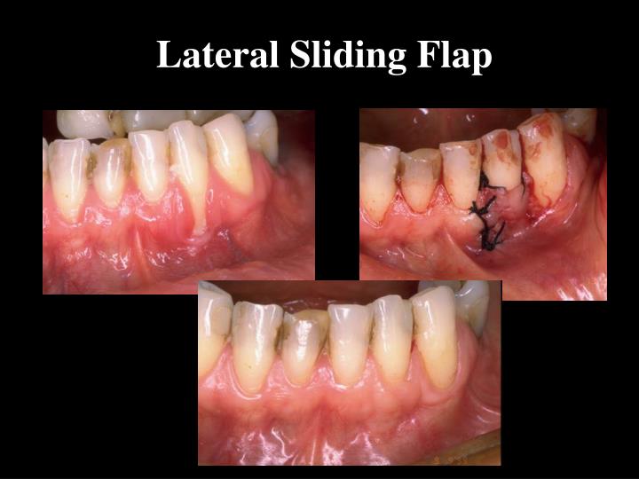 PPT - Periodontal Aesthetics PowerPoint Presentation - ID:4890149