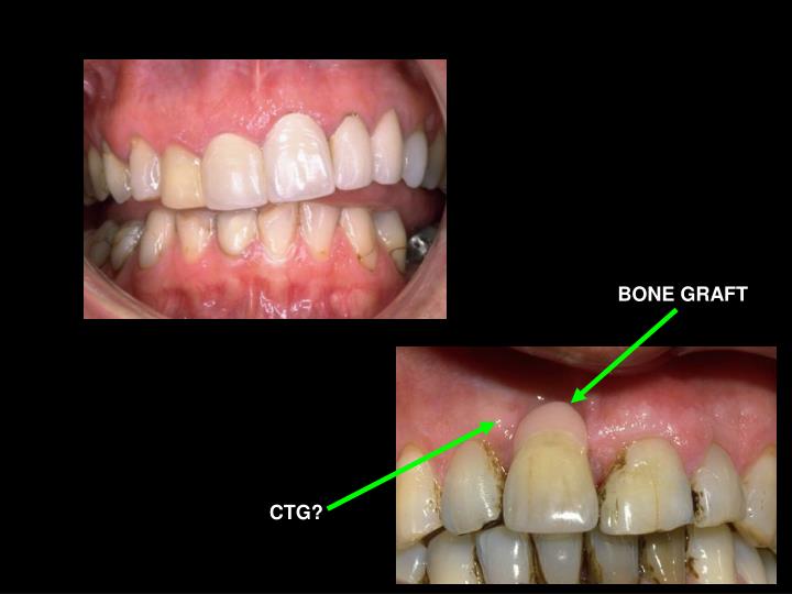 PPT - Periodontal Aesthetics PowerPoint Presentation - ID:4890149