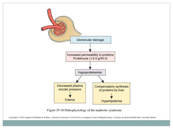 PPT - IDIOPATHIC NEPHROTIC SYNDROME IN CHILDREN PowerPoint Presentation ...