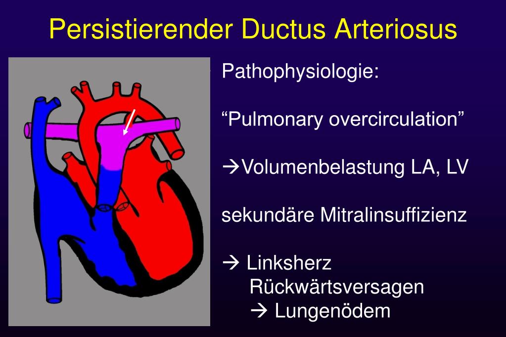 PPT - Persistierender Ductus arteriosus (PDA) Und der PON im Speziellen ...