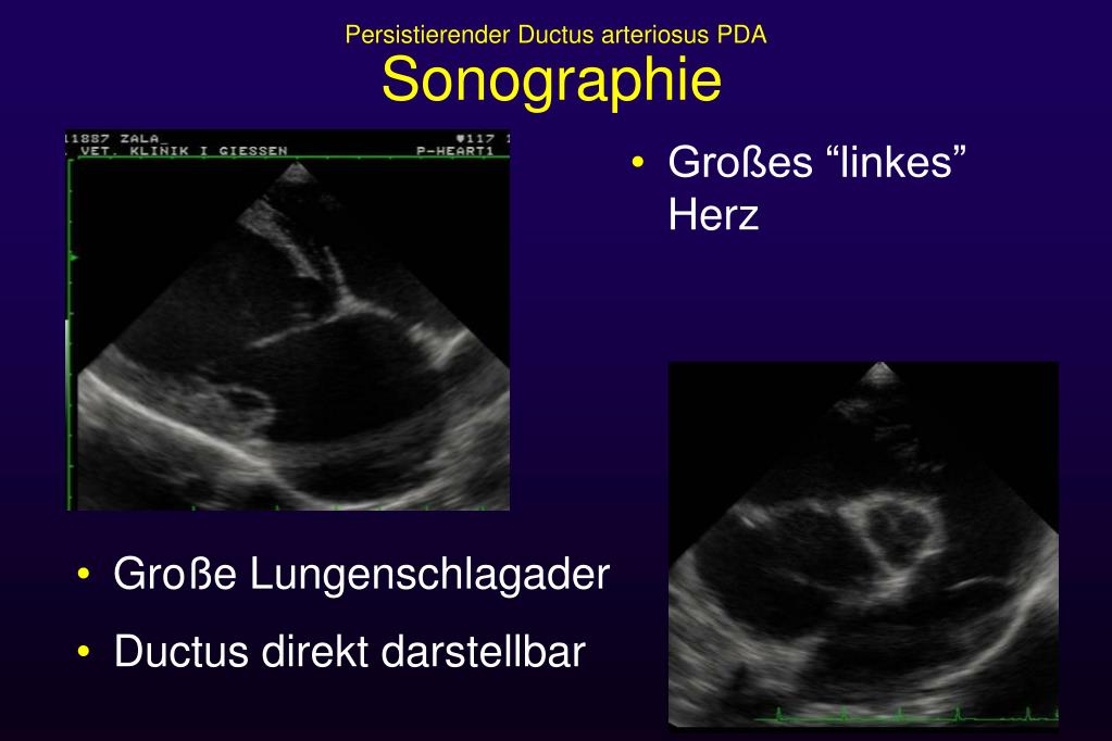 PPT - Persistierender Ductus arteriosus (PDA) Und der PON im Speziellen ...