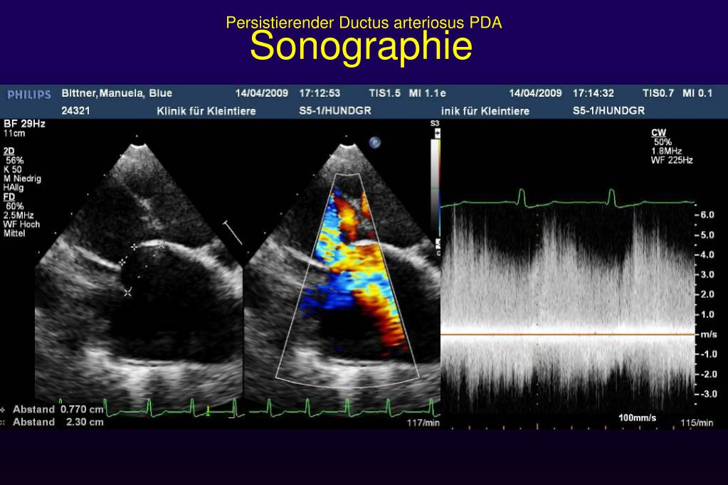 PPT - Persistierender Ductus arteriosus (PDA) Und der PON im Speziellen ...