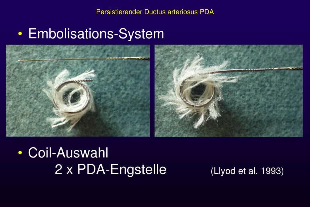 PPT - Persistierender Ductus arteriosus (PDA) Und der PON im Speziellen ...