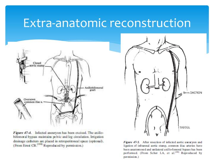 PPT - Review on Mycotic Aneurysm PowerPoint Presentation - ID:4894214