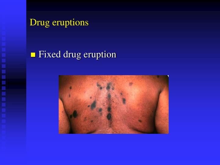 PPT - Common Exanthems PowerPoint Presentation - ID:4894554