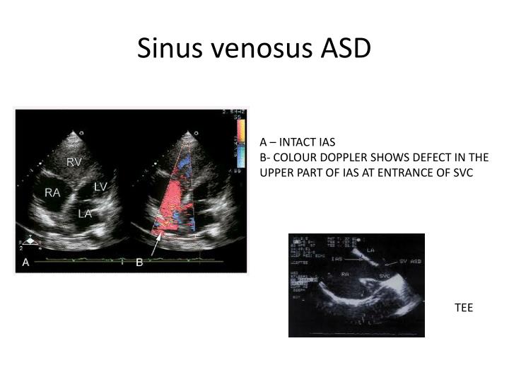 PPT - ECHO ASSESSMENT OF ATRIAL SEPTAL DEFECT PowerPoint Presentation ...