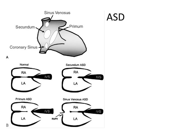 PPT - ECHO ASSESSMENT OF ATRIAL SEPTAL DEFECT PowerPoint Presentation ...