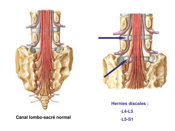 PPT - La Colonne Vertébrale Dr Palombi PowerPoint Presentation - ID:4895574