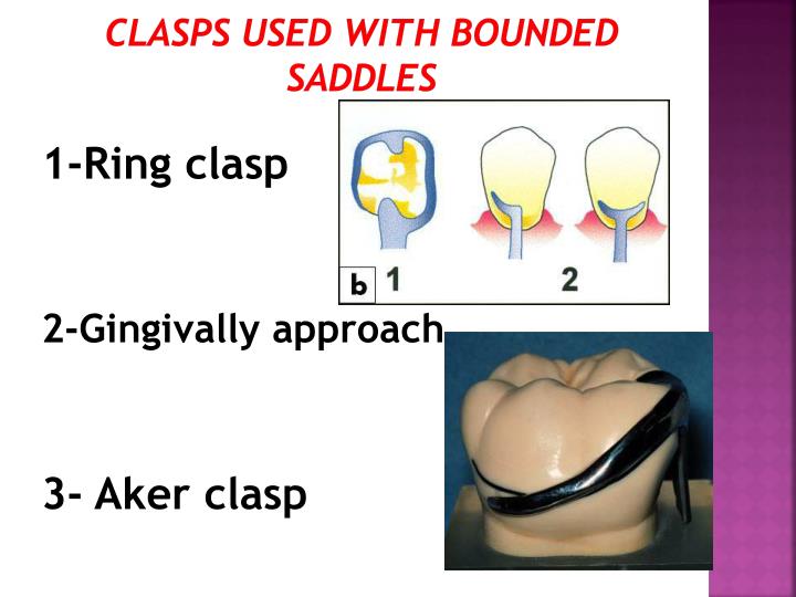PPT - Planning the design for removable partial dentures PowerPoint ...