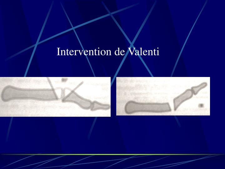 PPT - HALLUX RIGIDUS PowerPoint Presentation - ID:4912073