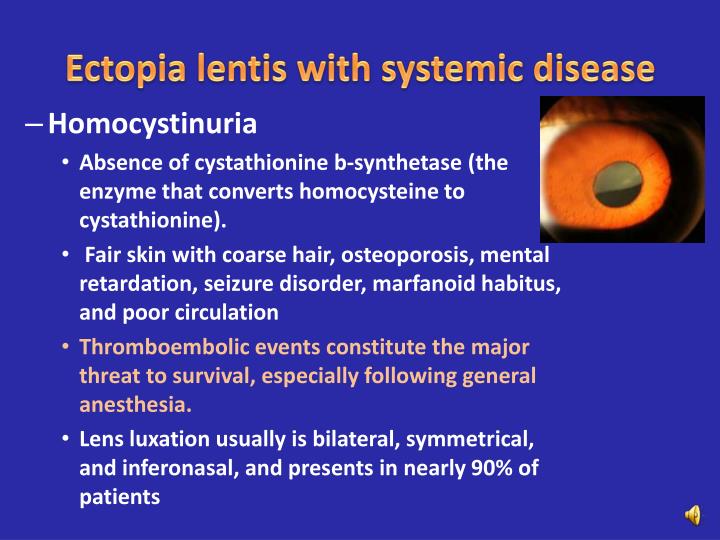 PPT - Ectopia Lentis PowerPoint Presentation - ID:4912491