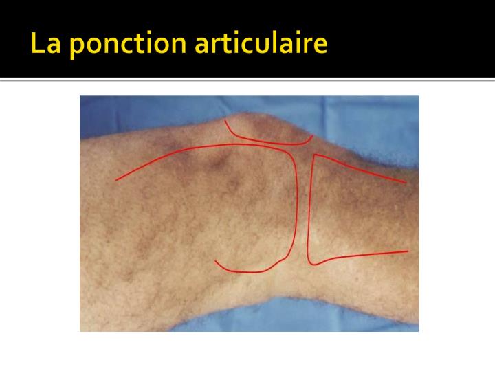 PPT - LA GONARTHROSE PowerPoint Presentation - ID:4921676