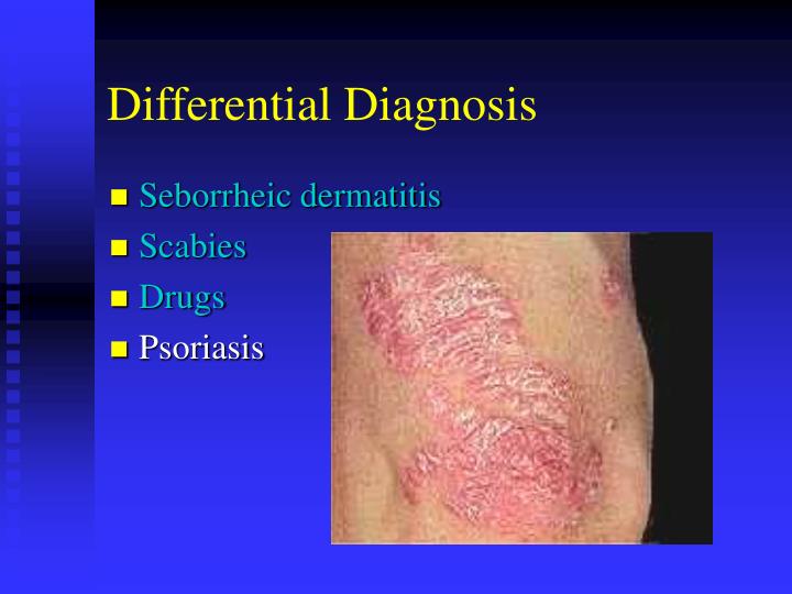 PPT - Atopic Dermatitis PowerPoint Presentation - ID:4929119