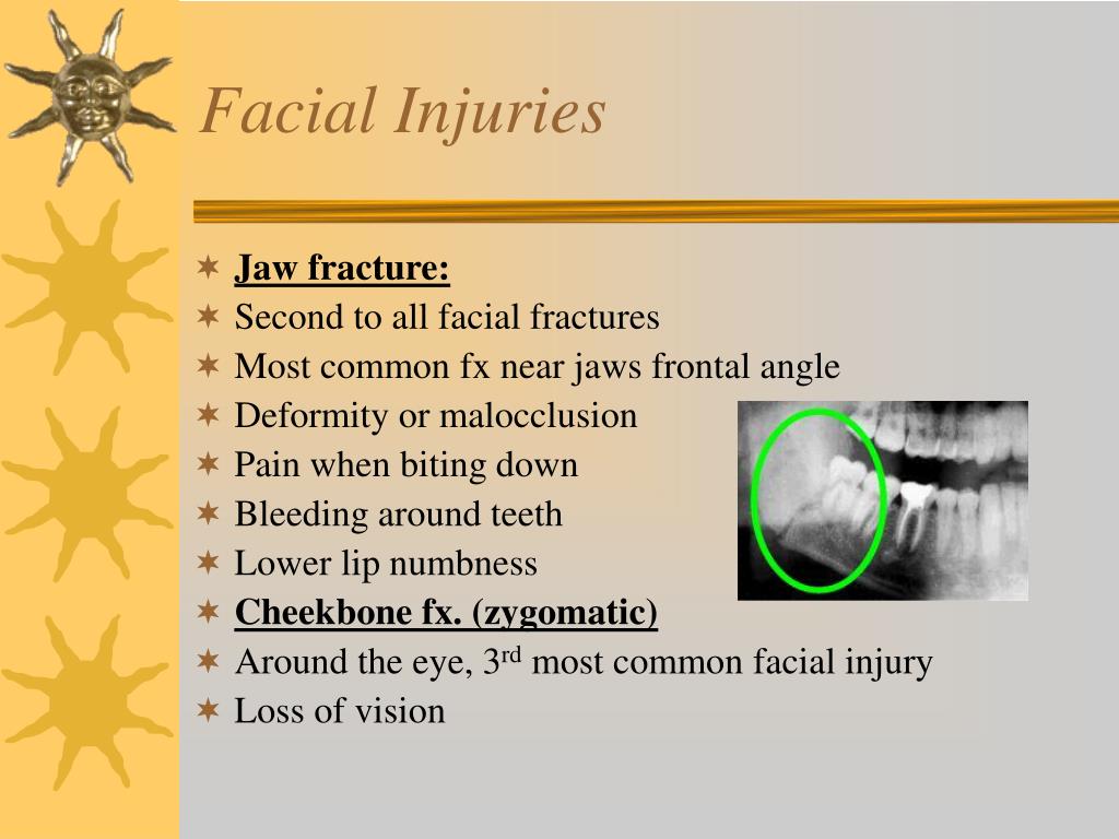 PPT - Sports Medicine HEAD Injuries PowerPoint Presentation, free ...