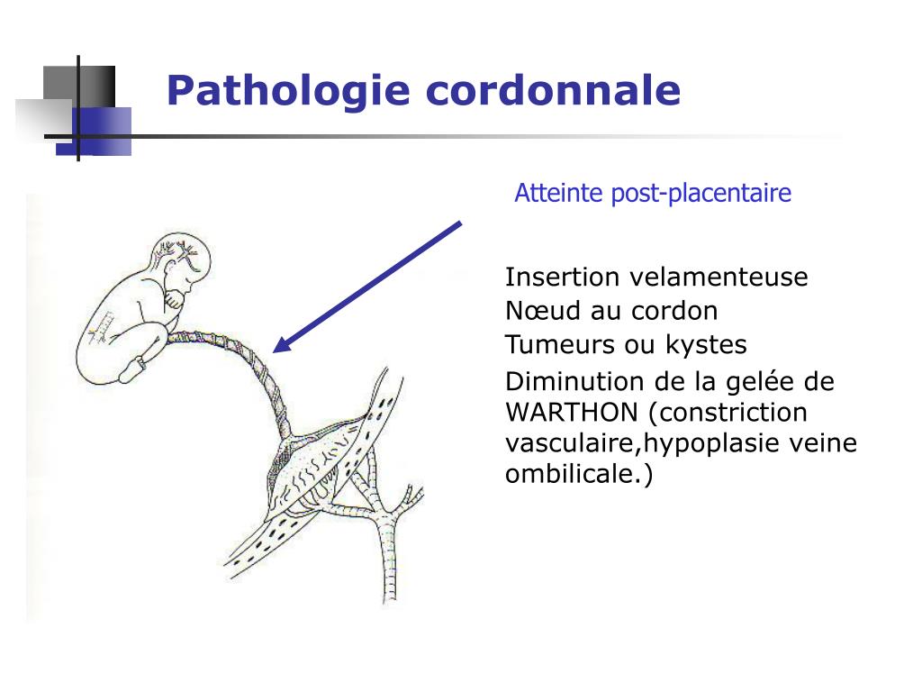 PPT - Souffrance fœtale chronique Etiologies PowerPoint Presentation ...