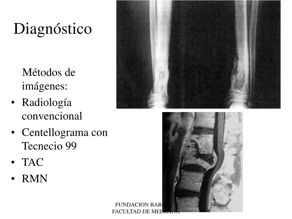 PPT - OSTEOMIELITIS PowerPoint Presentation, free download - ID:4943095 PPT - OSTEOMIELITIS PowerPoint Presentation, free download - ID:4943095