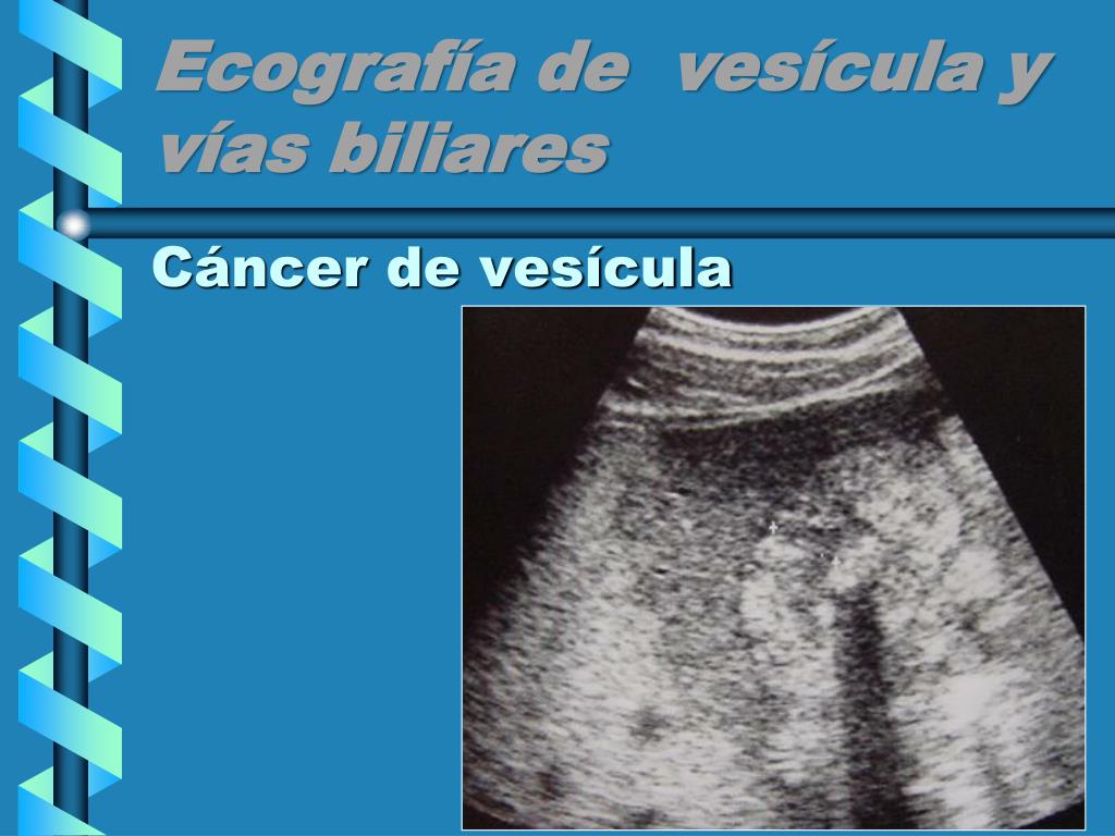 PPT - Ecografía de vesícula y vías biliares PowerPoint Presentation ...