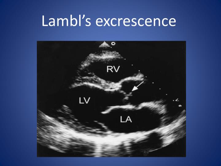PPT - Echo features of aortic stenosis PowerPoint Presentation - ID:4949845