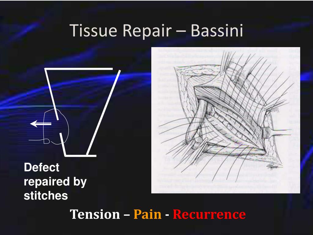 PPT - ETIOLOGY OF HERNIA & EVOLUTION OF HERNIA SURGERY PowerPoint ...