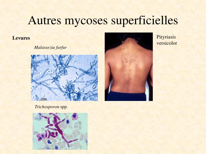 PPT - Les mycoses PowerPoint Presentation - ID:4963327