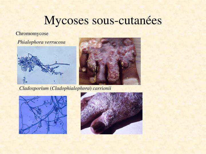 PPT - Les mycoses PowerPoint Presentation - ID:4963327