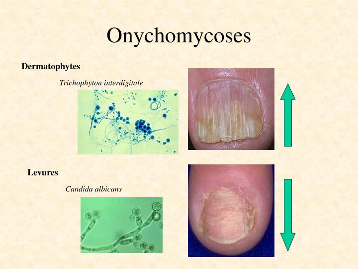 PPT - Les mycoses PowerPoint Presentation - ID:4963327