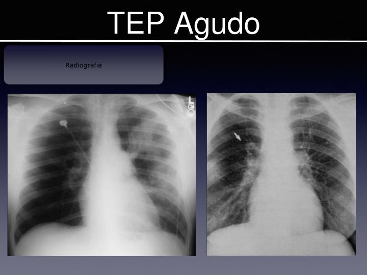 PPT - Imagens em Tromboembolismo Pulmonar PowerPoint Presentation - ID ...