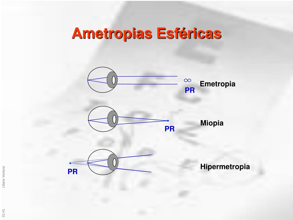 PPT - Princípio s da Retinoscopia e Função de Correção dos Vícios de ...