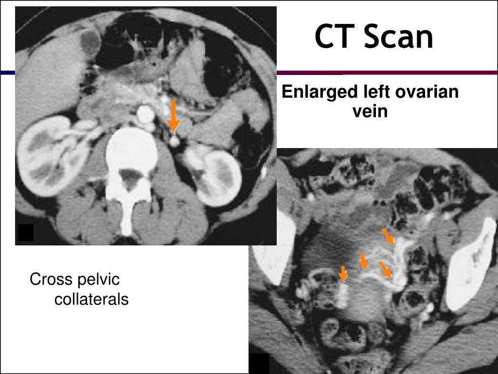 Ppt Endovascular Treatment Of Varicocele And Pelvic Congestion