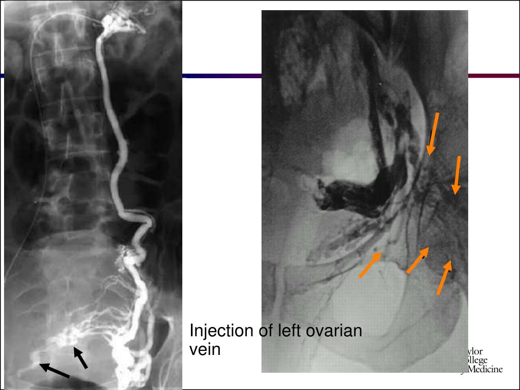Ppt Endovascular Treatment Of Varicocele And Pelvic Congestion