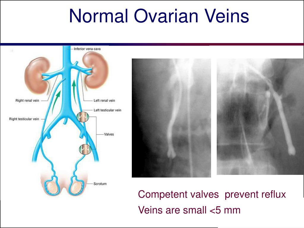 Ppt Endovascular Treatment Of Varicocele And Pelvic Congestion