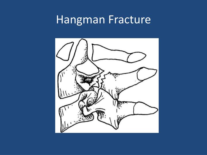 PPT - Spinal Injuries PowerPoint Presentation - ID:4990623