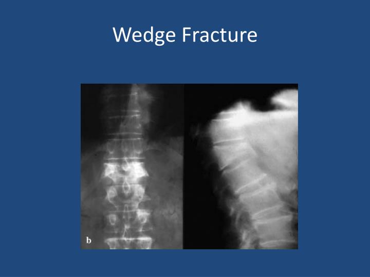 PPT - Spinal Injuries PowerPoint Presentation - ID:4990623