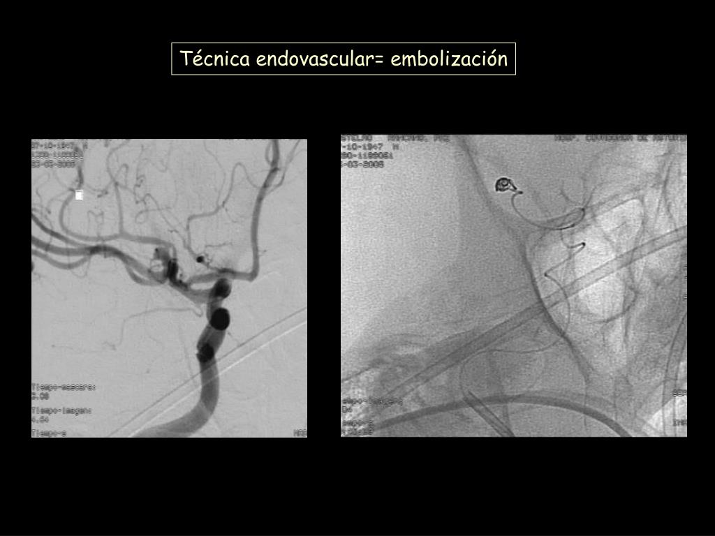 Ppt Tratamiento Endovascular De La Hsa AneurismÁtica Powerpoint