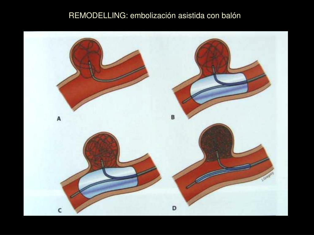 Ppt Tratamiento Endovascular De La Hsa AneurismÁtica Powerpoint