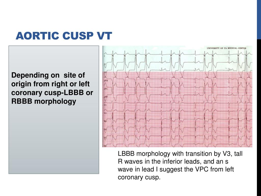 PPT - VENTRICULAR TACHYCARDIAS IN THE ABSENCE OF STRUCTURAL HEART ...