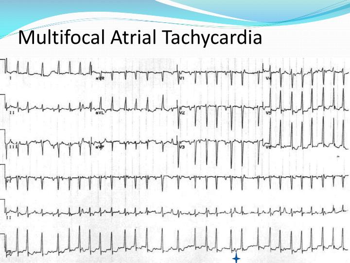 PPT - Narrow complex tachycardia PowerPoint Presentation - ID:5020229