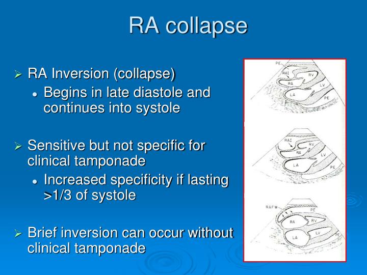 PPT - Cardiac Tamponade PowerPoint Presentation - ID:5026067