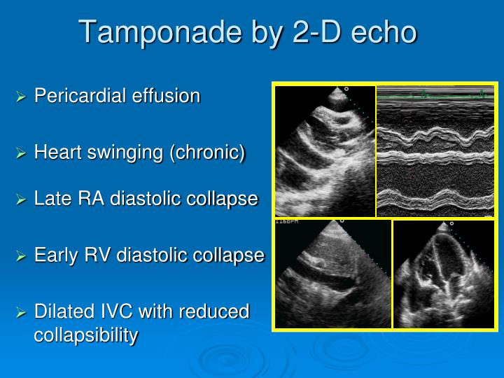 PPT - Cardiac Tamponade PowerPoint Presentation - ID:5026067