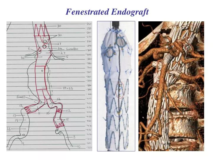 PPT - Fenestrated Endograft PowerPoint Presentation, free download - ID ...